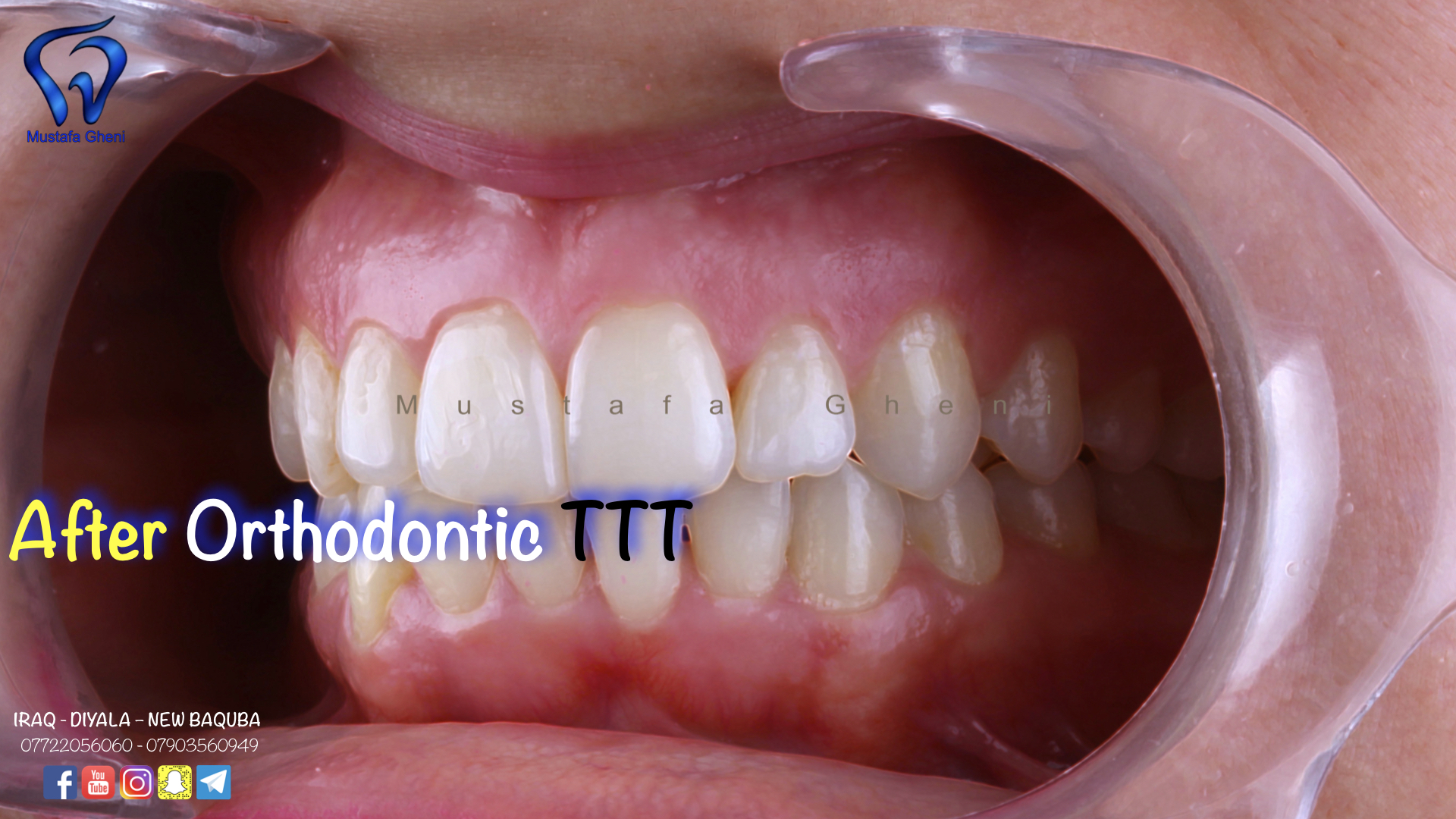 تقويم الاسنان - عيادات الدكتور مصطفى غني