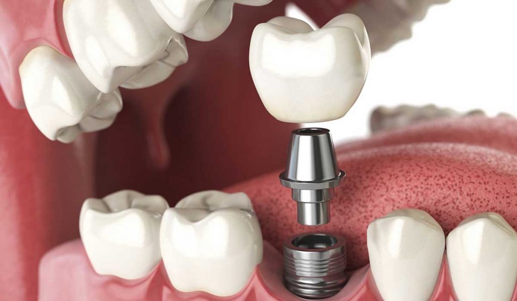 زراعة الاسنان - عيادات الدكتور مصطفى غني